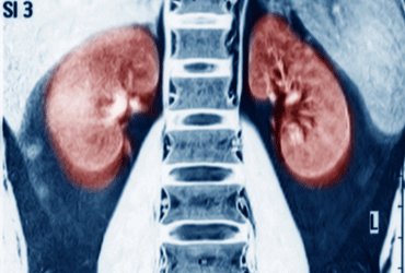 New Model to Predict Kidney Function During Chemotherapy