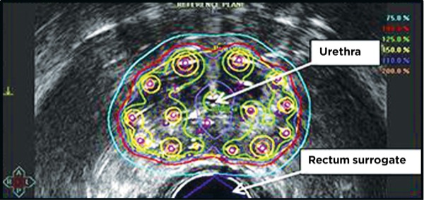 Good Outcomes With HDR Brachytherapy in Prostate Ca - Clinical Oncology ...
