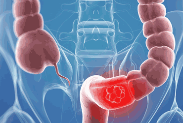 Surgical Site Infections Successfully Curbed by Colorectal Bundle