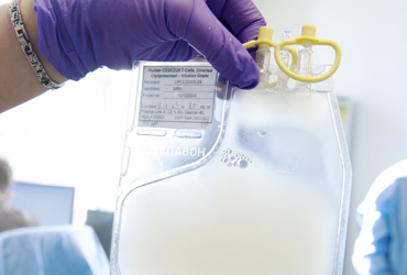 ALL Has Potential to Relapse After CAR T-Cell Therapy