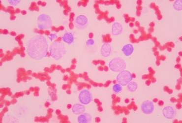 Study Finds Targeted Rx for More Than Half of AML Patients Via Genetic ...