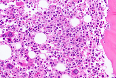 FDA Approves Inrebic to Treat Myelofibrosis