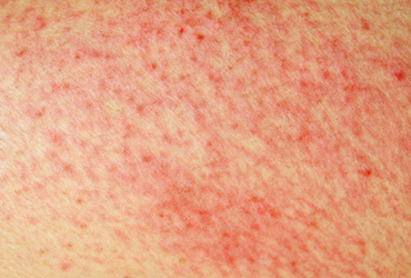 FDA Approves Jakafi to Treat Acute GVHD