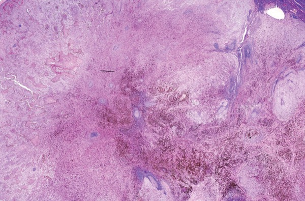 What Is Value of Therapeutic Lymph Node Dissection in Melanoma ...