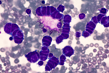 FDA Approves Zepzelca as New Option for Metastatic SCLC