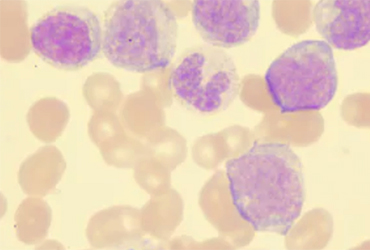 FDA Approves Inqovi, a New Oral Combination for MDS