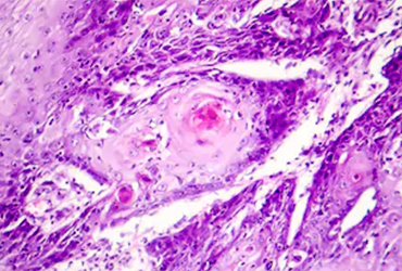 Keytruda Approved for Recurrent or Metastatic Cutaneous Squamous Cell ...