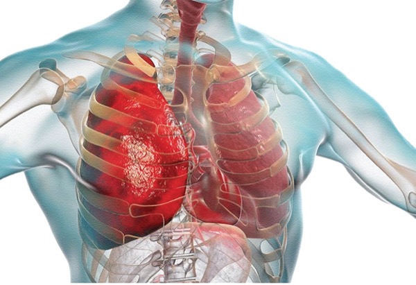 Large Study Sheds Light on Pneumonitis in NSCLC - Clinical Oncology News