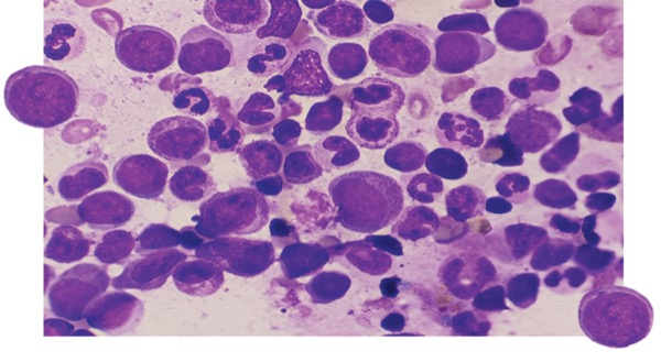 AML Rx Evolves With Growing List of Options - Clinical Oncology News