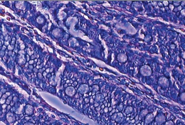 Breath Analysis Fairly Accurate For Detecting Gastric Cancer