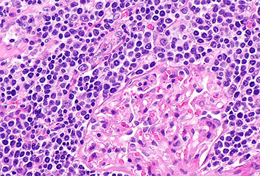 Copanlisib Plus Rituximab Yields Large PFS Benefit in MZL