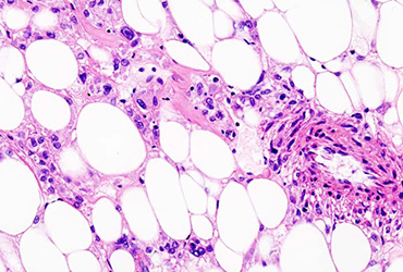 FDA Approves Fyarro for Perivascular Epithelioid Cell Tumor