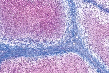 Early PVT Detection Crucial for Hospitalized Cirrhosis Patients With ...