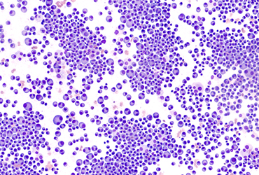 FDA Approves First Cell-Based Gene Therapy for Multiple Myeloma