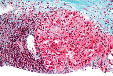 BCLC 2022 Update Focuses on Personalizing Treatment