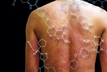 New Approvals For GVHD Expand Treatment Options