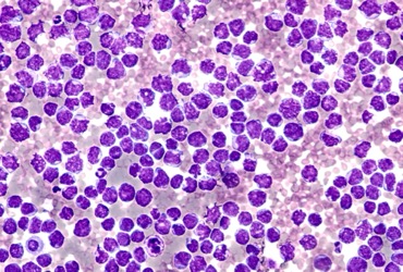 Relapsed/Refractory Mantle Cell Lymphoma: Promising Treatments on the ...