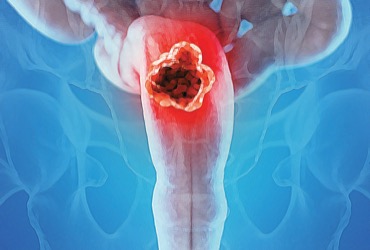 Progress Shown in Digestive Tract Cancer Treatments