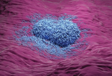 Albumin-Bilirubin Grade Proposed as Prognostic Tool in Hepatocellular ...