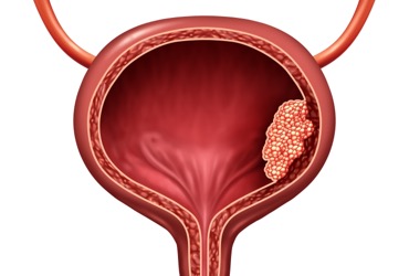 Study Provides New First-Line Standard for Advanced Bladder Cancer